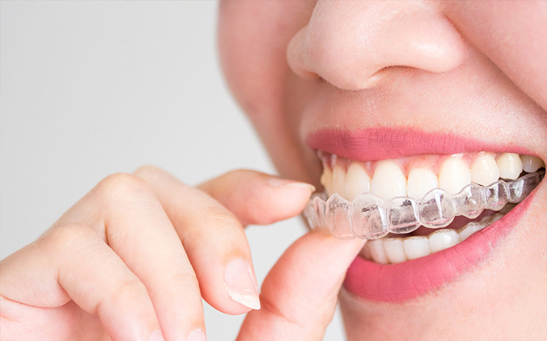 Mobile Teeth Solution in Jalandhar - Malhan Dental Clinic